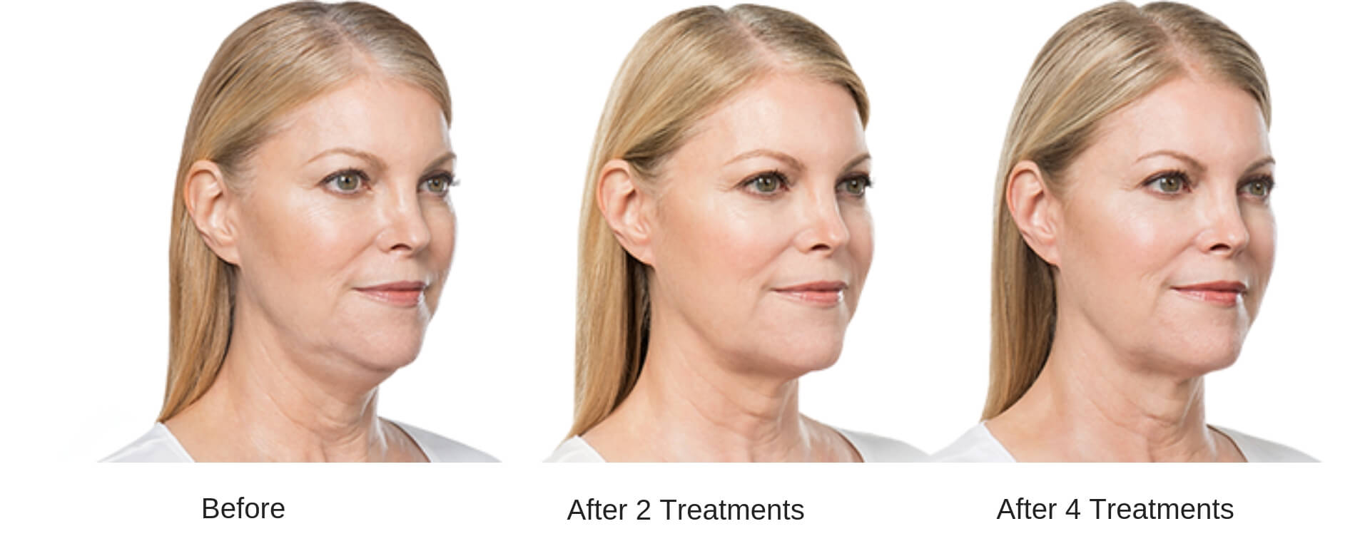 Kybella Colorado Springs, CO | Double Chin Reduction