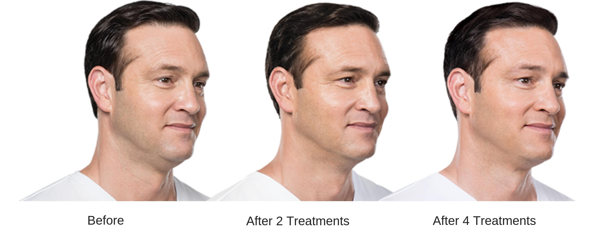 Kybella Colorado Springs, CO | Double Chin Reduction