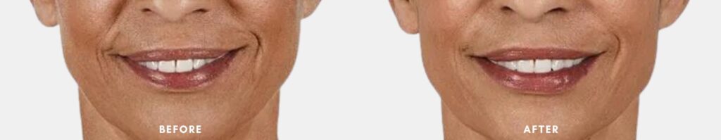 Lip Fillers Denver, CO | Lip Injections in Denver