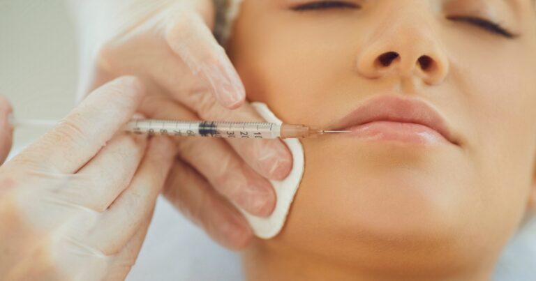Lip Filler Migration: What It Is, Why It Happens, and How to Avoid It
